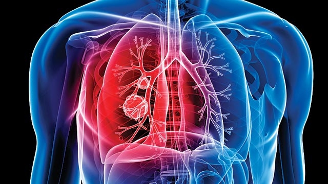 TB Patients In India Could Be Much Higher Study Latest News tb-patients-in-india-could-be-much-higher-study-latest-news